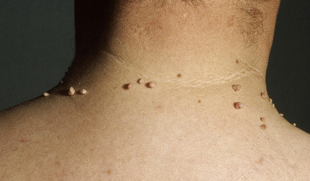 مرض الثالول وعشر علاجات طبيعية تساعدك على التخلص منه - Tops Arabia